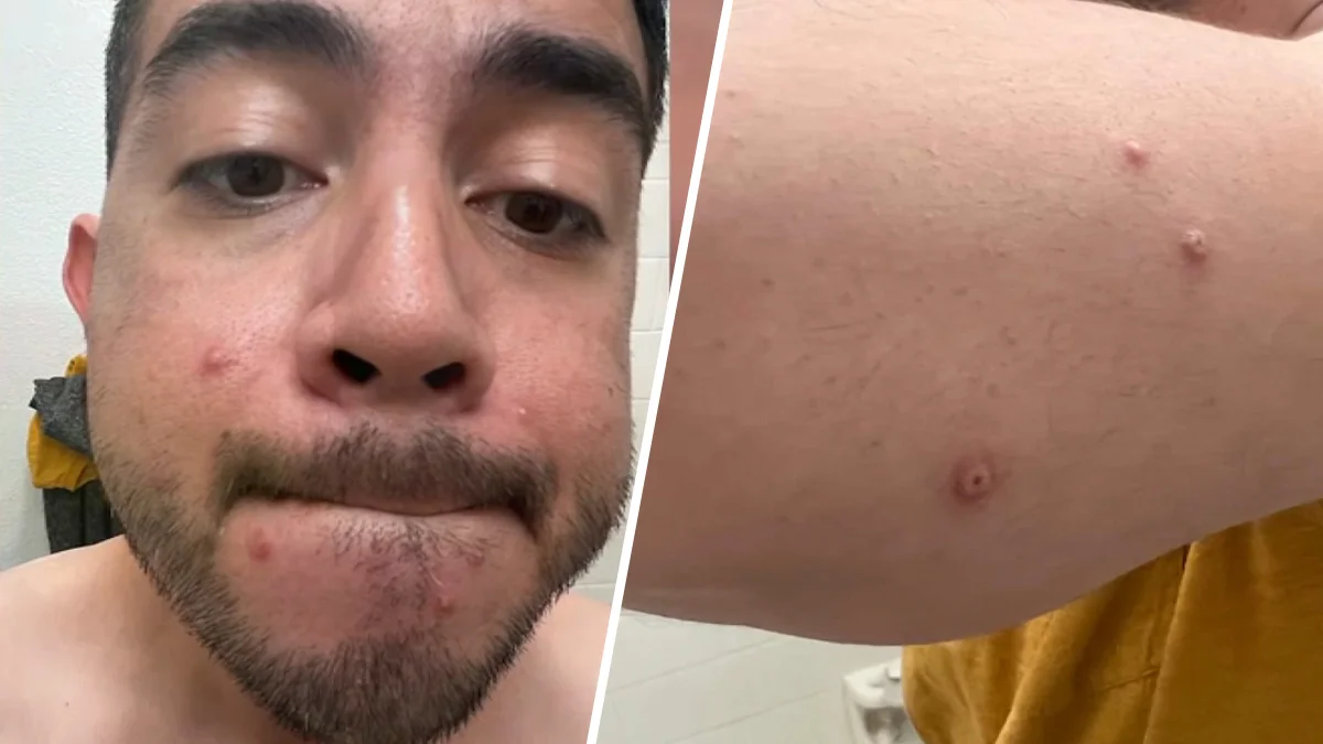 México suman mil 968 casos de viruela del mono; aumentaron 341 en una ...